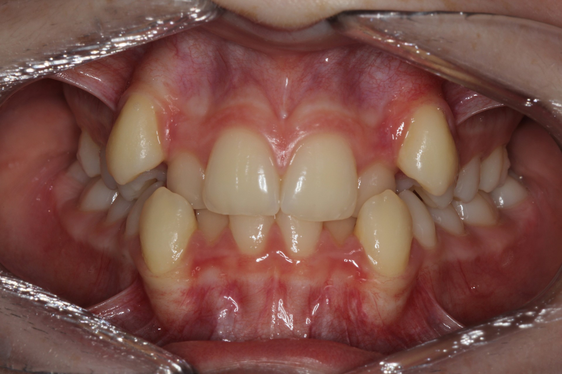 Bite Problems Contour Orthodontists