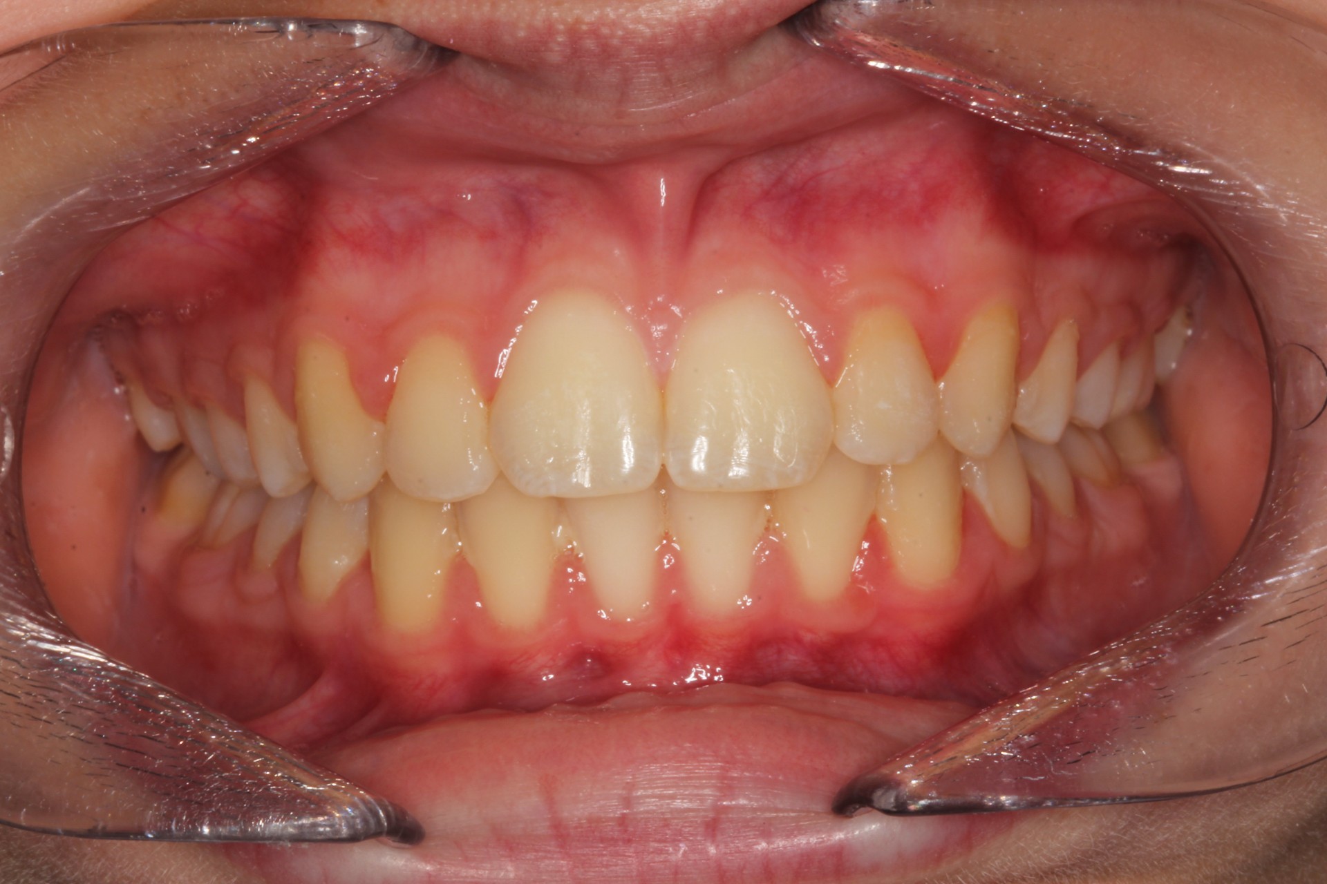 Protruding Front Teeth | Contour Orthodontists