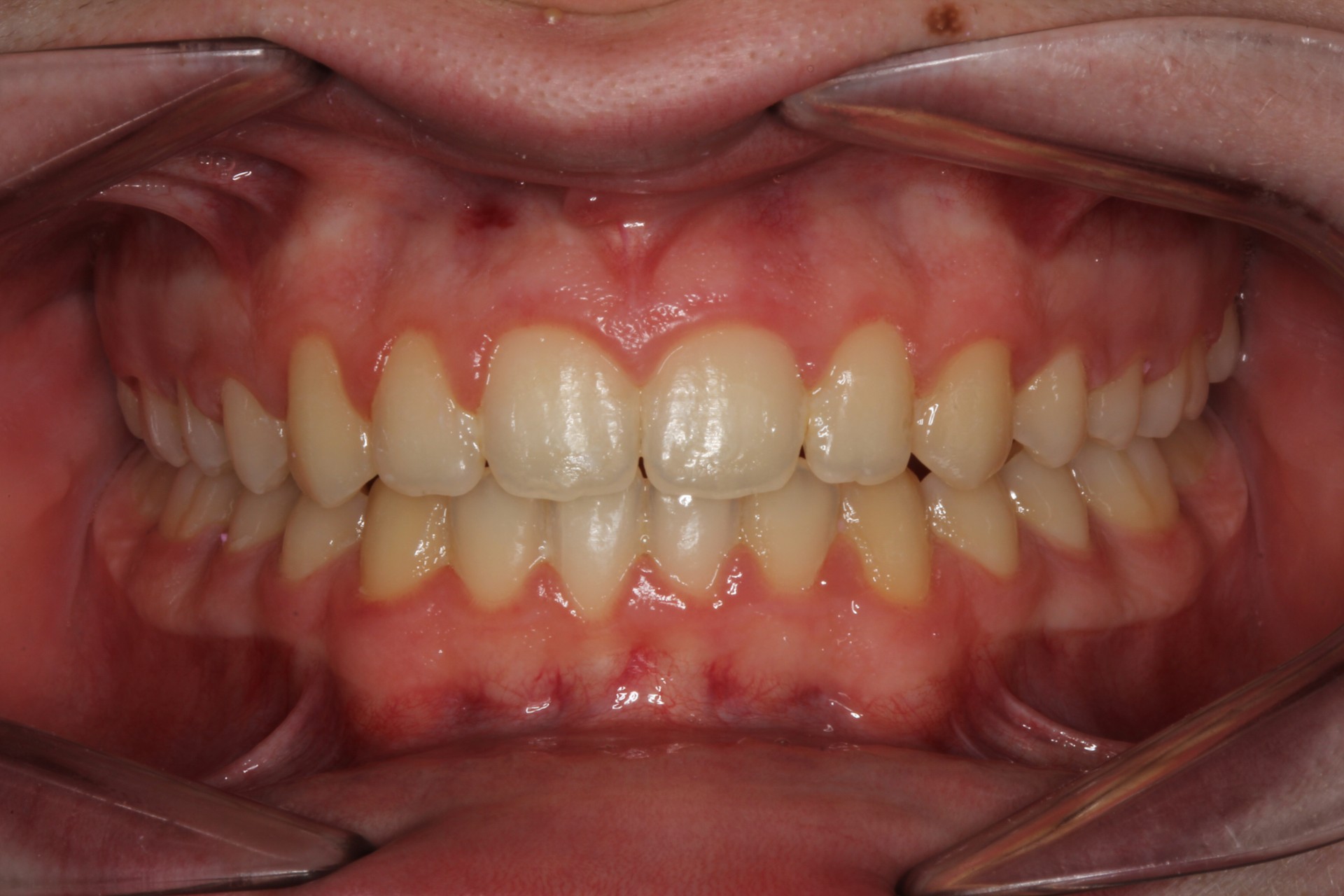 Crowded Teeth | Contour Orthodontists