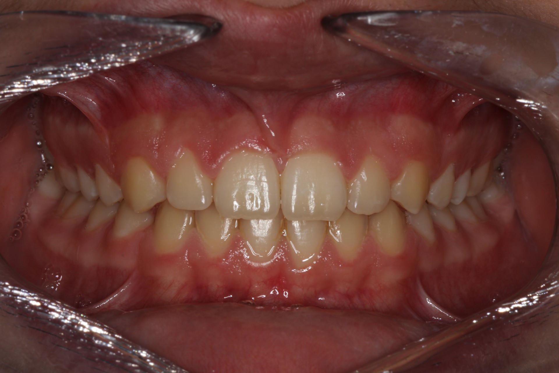 Gappy Teeth | Contour Orthodontists