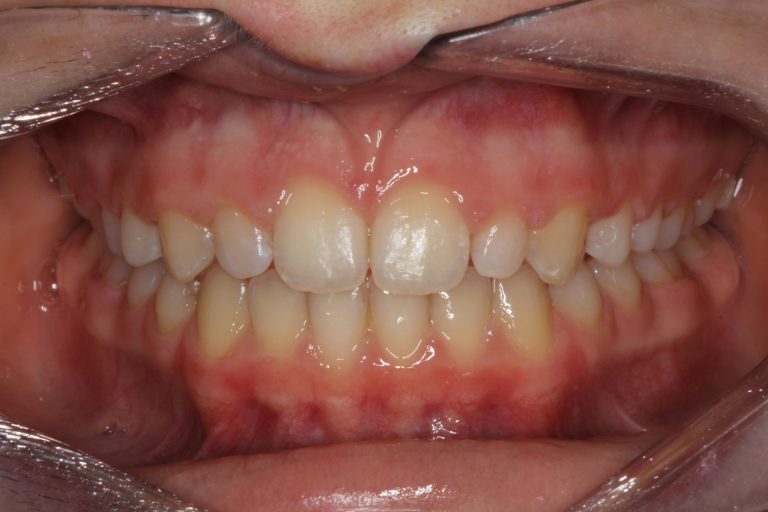 Protruding Front Teeth | Contour Orthodontists