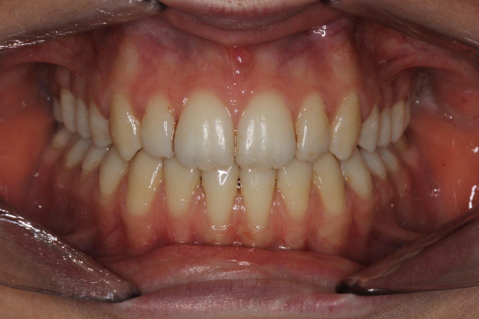 Bite Problems | Contour Orthodontists