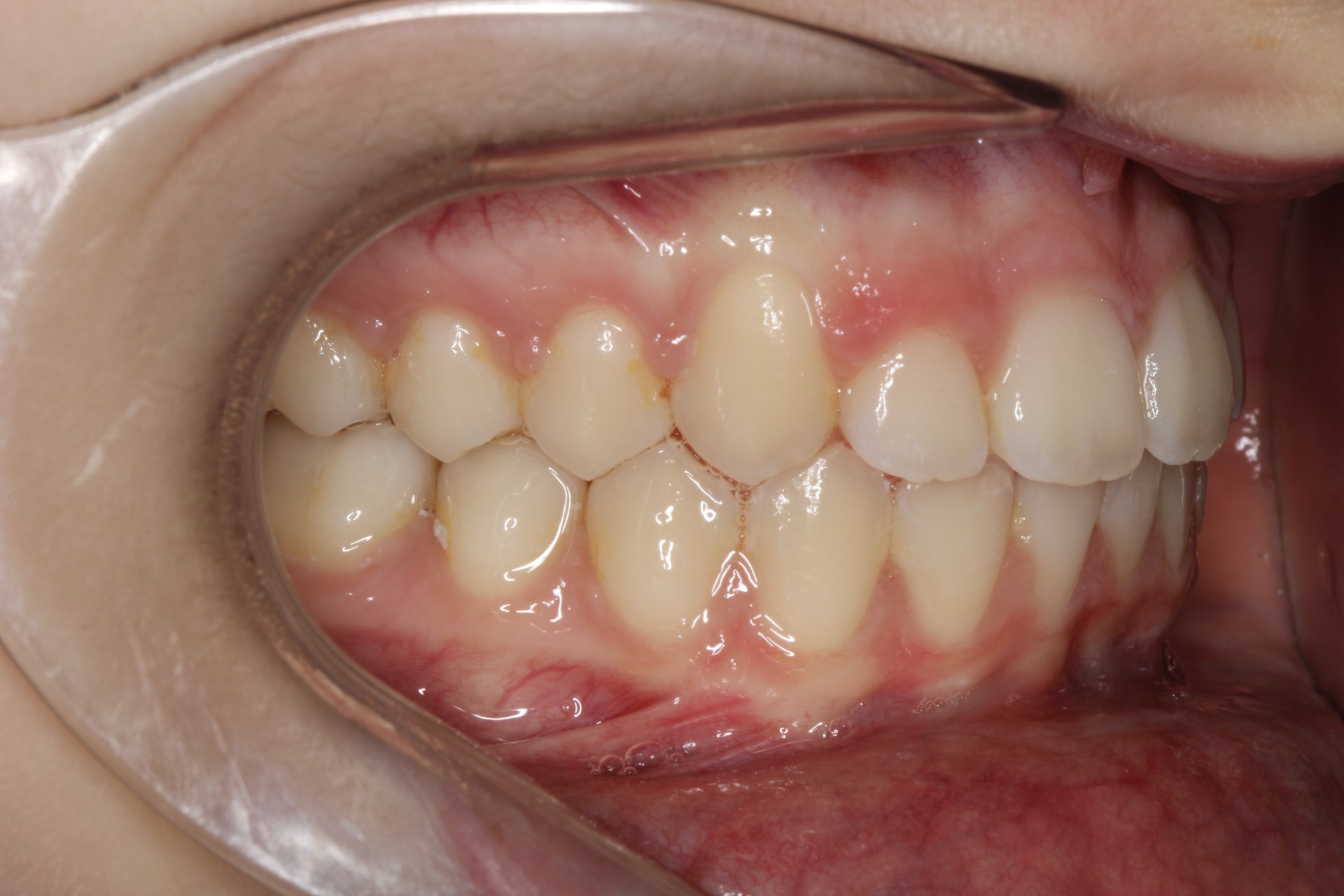 Bite Problems Contour Orthodontists