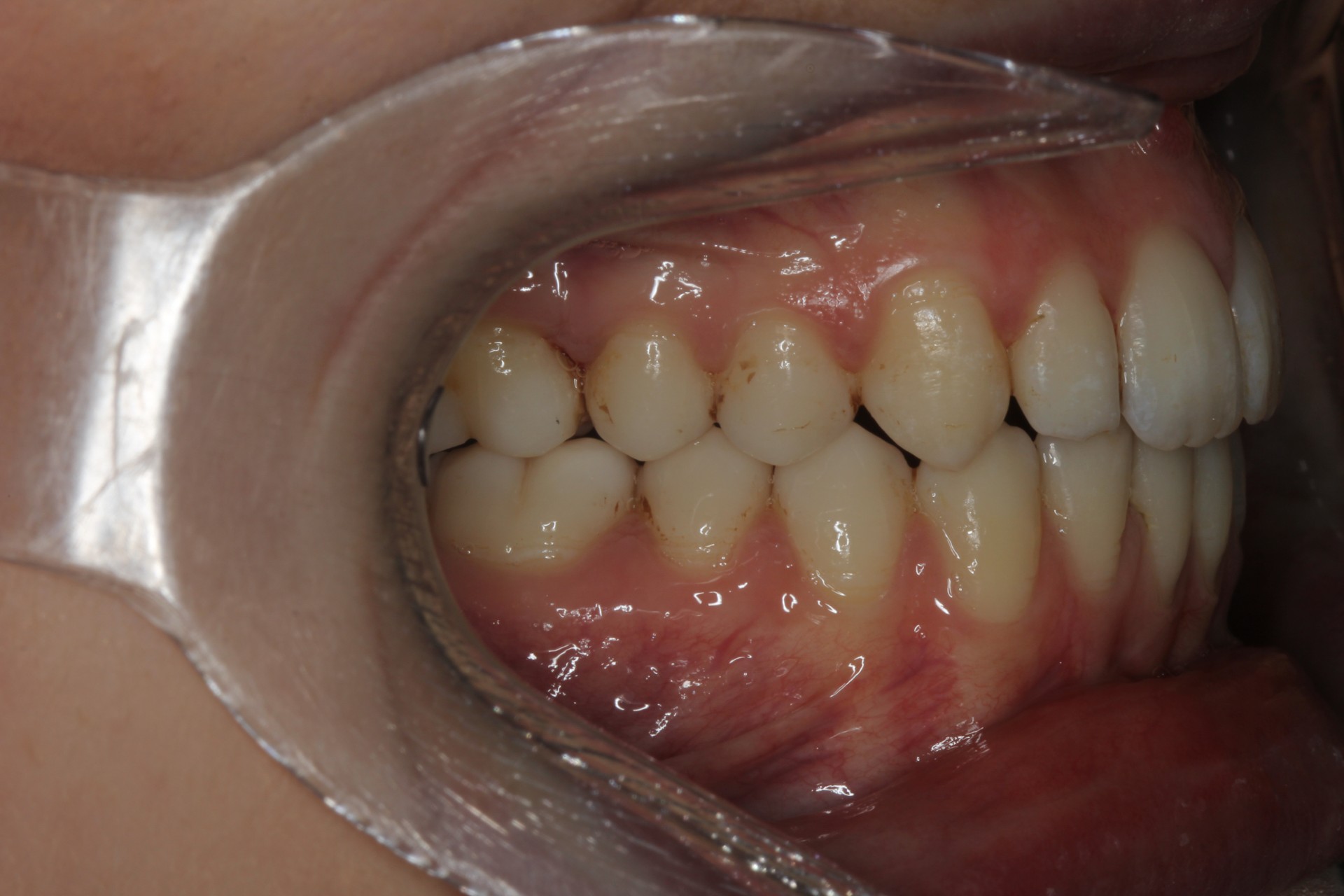 Bite Problems | Contour Orthodontists