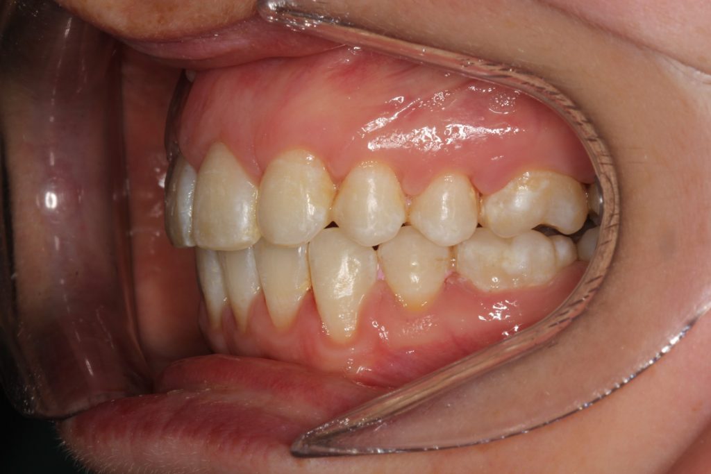 Missing Teeth | Contour Orthodontists