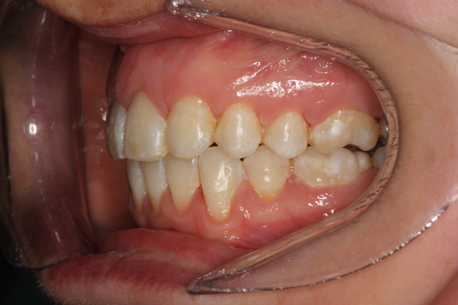 Missing Teeth | Contour Orthodontists